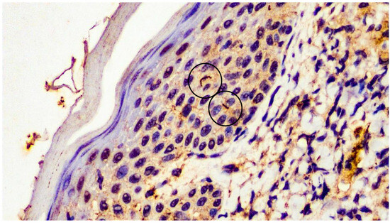 Granulomatous Secondary Syphilis: A Case Report with a Brief Overview ...