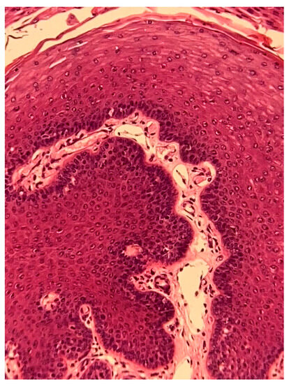 Bovine Papillomavirus Type 1 Infection in an Equine Congenital Papilloma