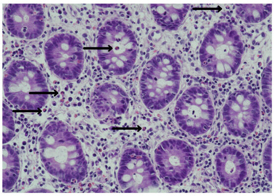 A Case of Gastroallergic and Intestinal Anisakiasis in Italy: Diagnosis ...