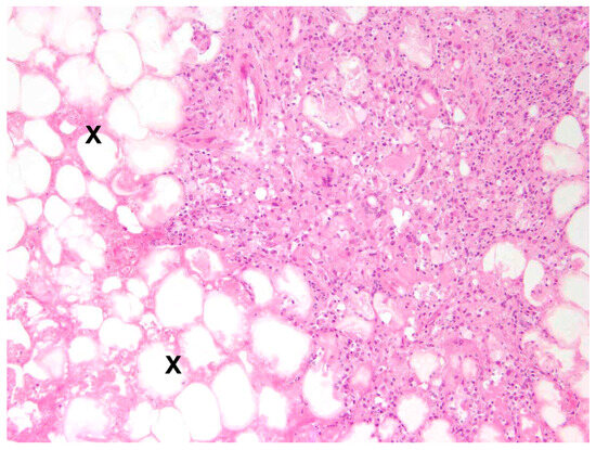 Pathomorphological Findings and Infectious Diseases in Selected ...
