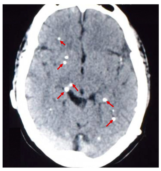 Calcified Neurocysticercosis: Demographic, Clinical, and Radiological ...