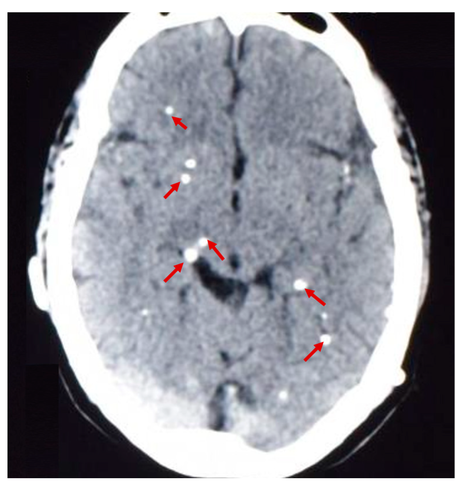 Calcified Neurocysticercosis: Demographic, Clinical, and Radiological Characteristics of a Large ...