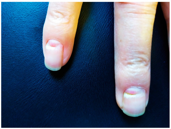 Beau’s Lines and COVID-19; A Systematic Review on Their Association