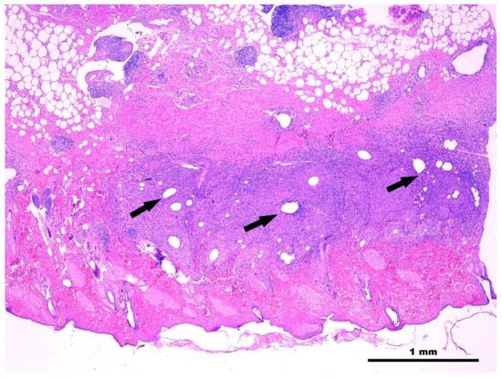 Genomics Insights into Mycolicibacterium Hassiacum Causing Infection in ...