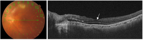 Ocular Toxoplasmosis: Advances in Toxoplasma gondii Biology, Clinical ...