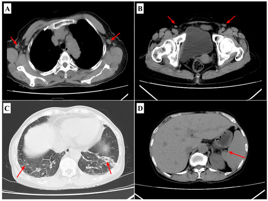 Comprehensive Laboratory Analysis of a Scrub Typhus and H1N1 Influenza ...