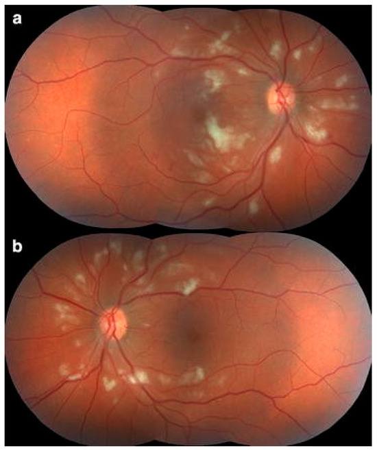 Dengue-Related Ocular Complications: Spectrum, Diagnosis, and Management