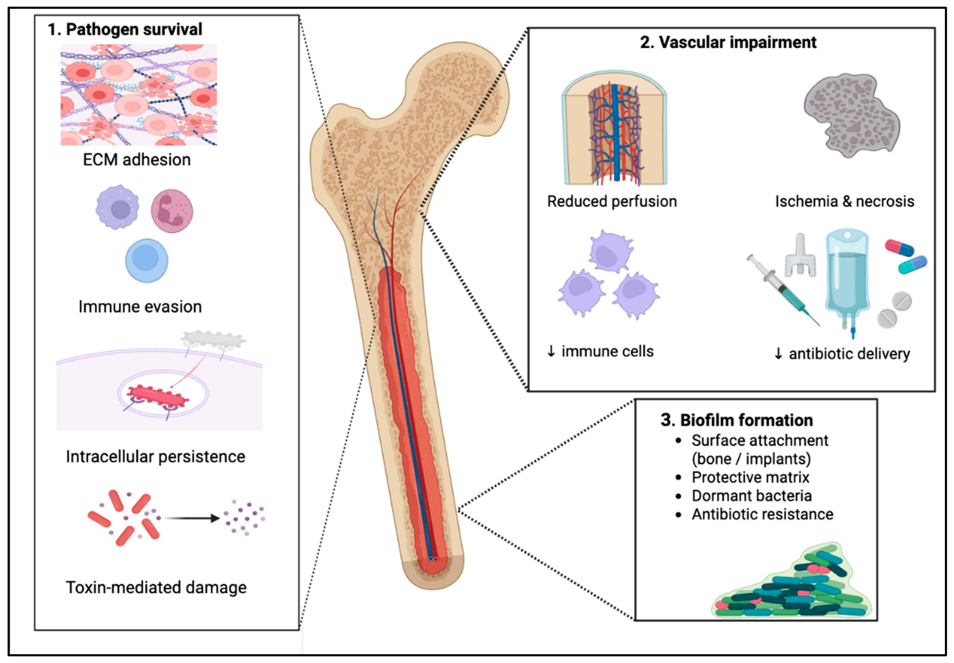 Managing Bone Infections Beyond Systemic Antibiotics: A Scoping Review