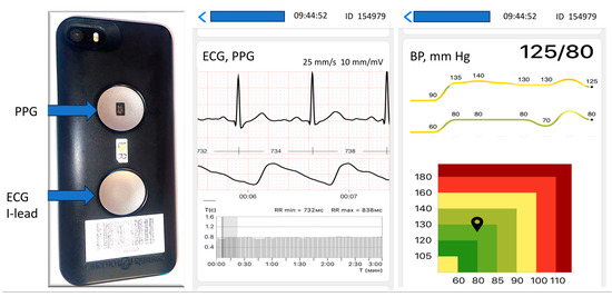 Practical Application of a New Cuffless Blood Pressure Measurement Method