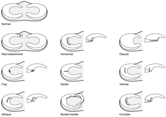 Surgical Management of Traumatic Meniscus Injuries