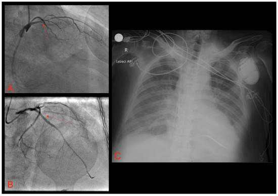 A Refractory Electrical Storm after Acute Myocardial Infarction: The ...