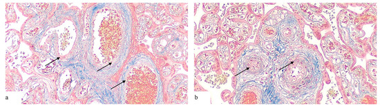 Placental Macrovascular Pattern from Pregnancies with Maternal ...
