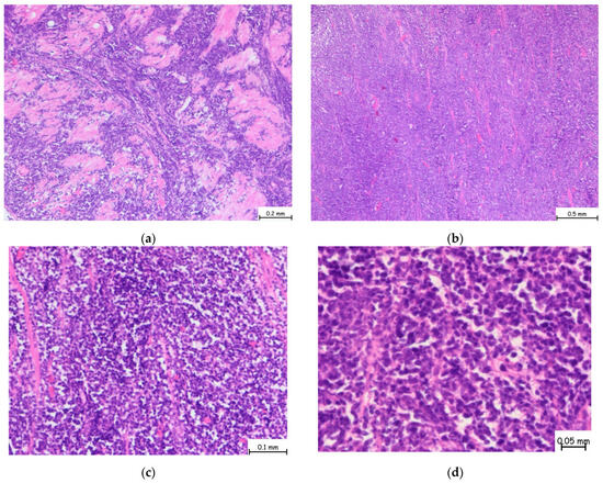 Secondary Prostate Lymphoma Mimicking Prostate Cancer Successfully ...