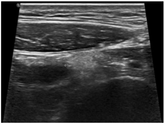 Epiploic Appendagitis and Omental Infarction as Rare Causes of Acute ...