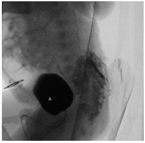 Exstrophy-Epispadias Complex Variants: A Hybrid Case