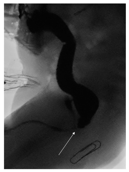 Pediatric Reports | Free Full-Text | Triple Atresia, Triple Threat? An ...