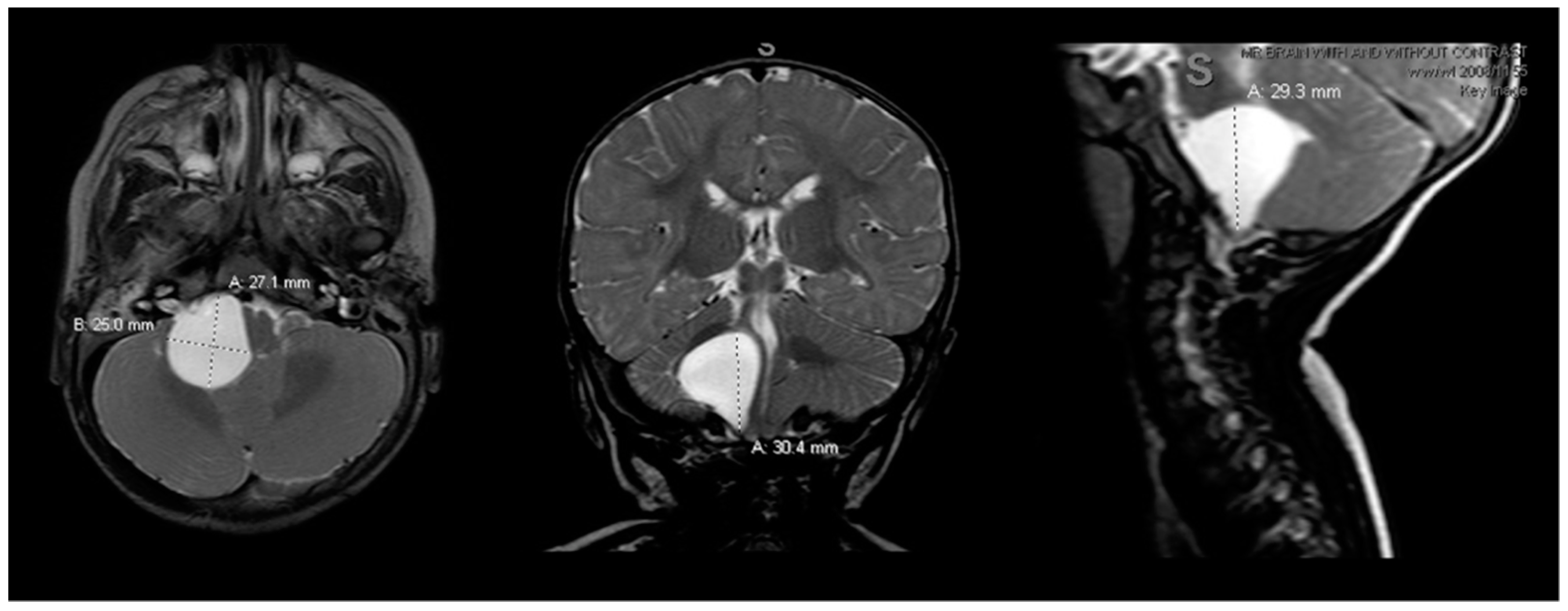 A Case of Torticollis in an 8-Month-Old Infant Caused by Posterior ...