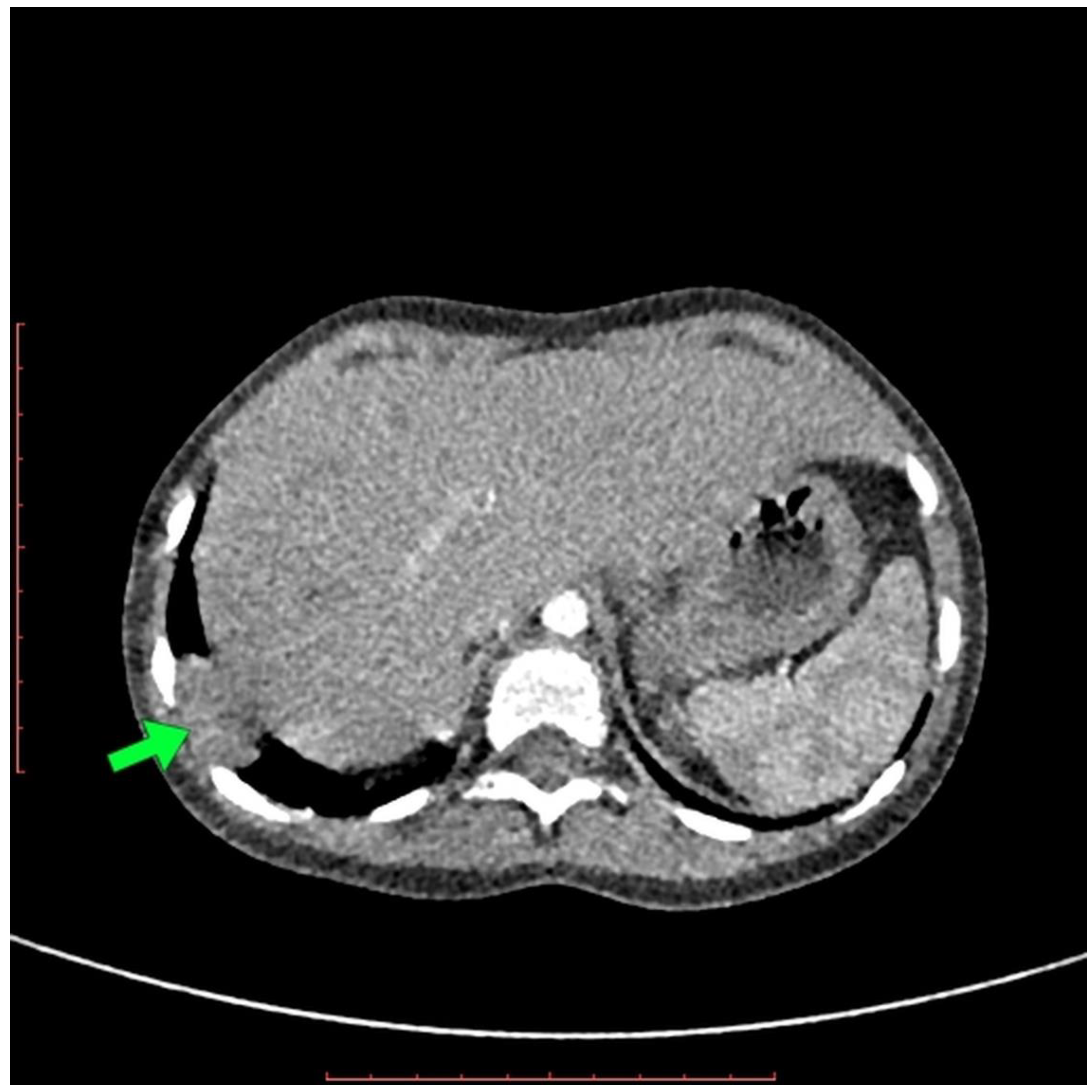 Ingrowing Liver as Atypical Recurrent Diaphragmatic Hernia Presentation ...