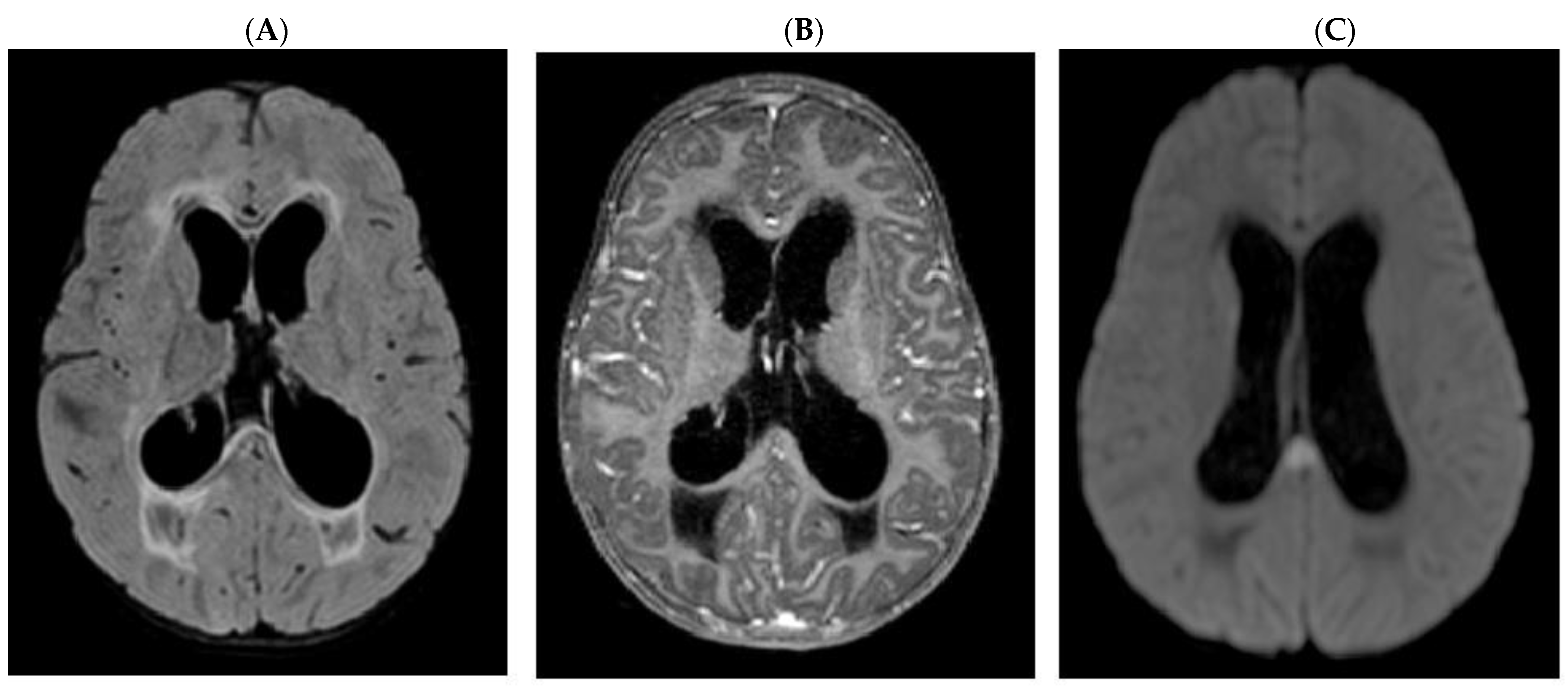 A Fatal Case of Tuberculosis Meningitis in Previously Health Children