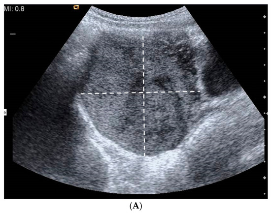 A Rare Ovarian Tumor: The Sclerosing Stromal You Do Not Expect—A Case ...