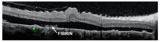Bullous Central Serous Chorioretinopathy: A Rare and Atypical Form of ...