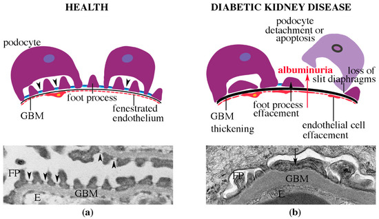 Metformin Protects against Podocyte Injury in Diabetic Kidney Disease