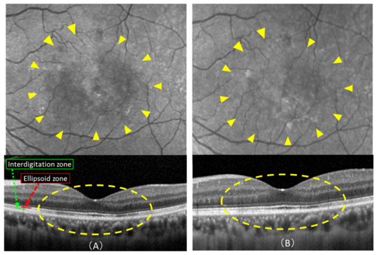Morphological Changes and Prognostic Factors before and after ...