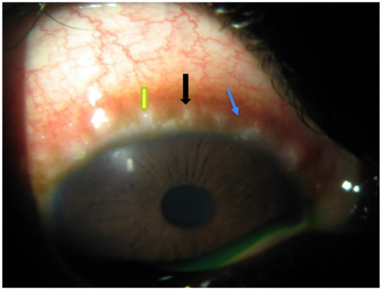 Immunopharmacology in Vernal Keratoconjunctivitis: Current and Future ...