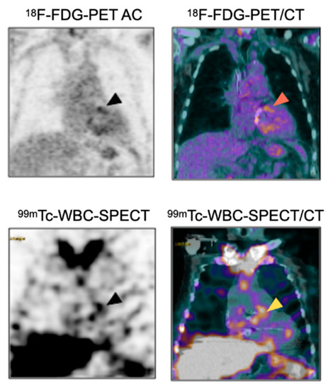 Nuclear Imaging in Infective Endocarditis