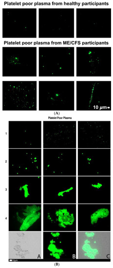 The Occurrence of Hyperactivated Platelets and Fibrinaloid Microclots ...