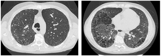 The Challenge of Diagnosing and Managing Pulmonary Arterial ...