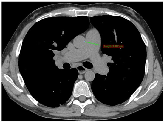 The Challenge of Diagnosing and Managing Pulmonary Arterial ...
