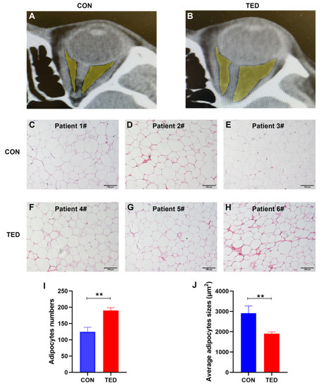 Repurposing Lenvatinib as A Potential Therapeutic Agent against Thyroid ...