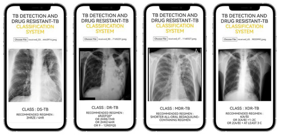 Drug-Resistant Tuberculosis Treatment Recommendation, and Multi-Class ...