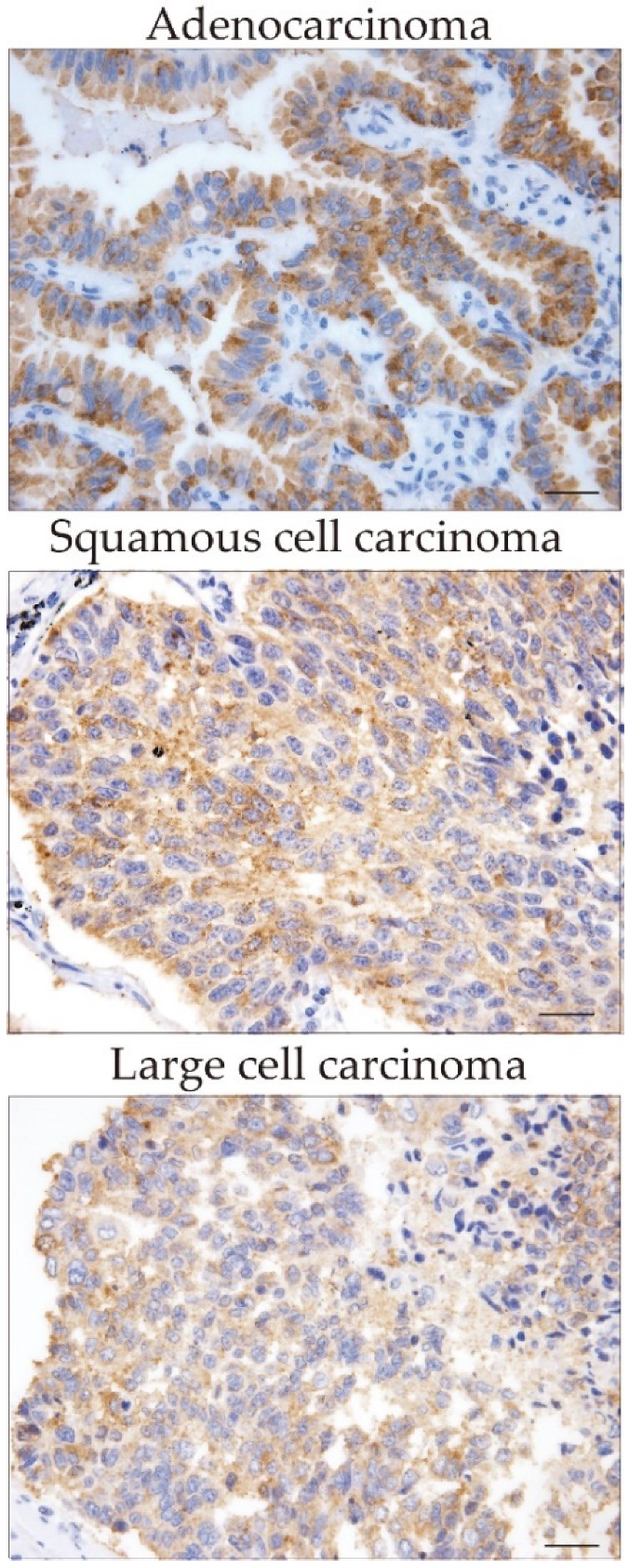 Non Small Cell Adenocarcinoma