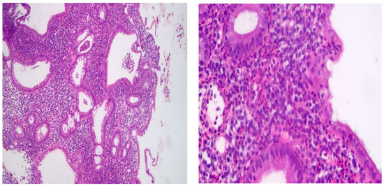 Mucosal Genes Expression in Inflammatory Bowel Disease Patients: New ...