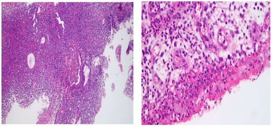 Mucosal Genes Expression in Inflammatory Bowel Disease Patients: New ...