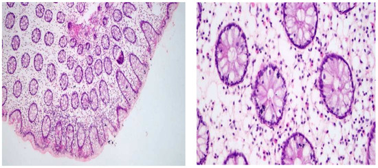 Mucosal Genes Expression in Inflammatory Bowel Disease Patients: New ...