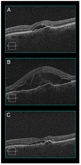 Half-Fluence, Half-Dose Photodynamic Therapy: Less Direct Damage but ...