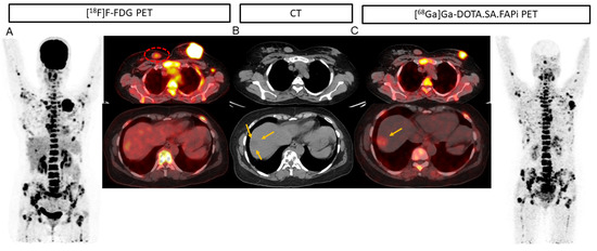 Head-to-Head Comparison between [68Ga]Ga-DOTA.SA.FAPi and [18F]F-FDG PET/CT Imaging in Patients ...