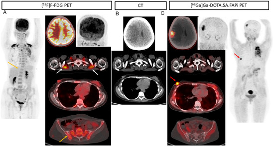 Head-to-Head Comparison between [68Ga]Ga-DOTA.SA.FAPi and [18F]F-FDG PET/CT Imaging in Patients ...