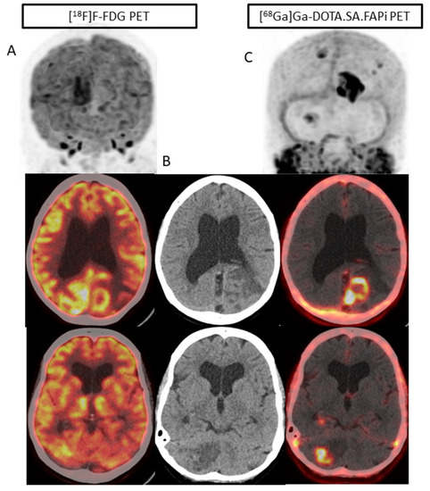Head-to-Head Comparison between [68Ga]Ga-DOTA.SA.FAPi and [18F]F-FDG PET/CT Imaging in Patients ...