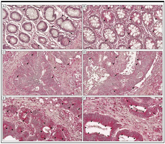 Immunohistochemical Expression of Glutathione Peroxidase 1 (Gpx-1) as ...