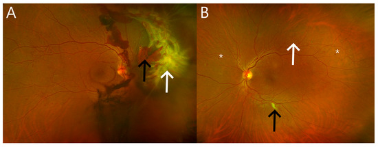 Intravitreal Anti-Vascular Endothelial Growth Factor Therapies for ...