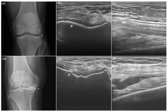 Concurrent Imaging and Clinical Study of the Efficacy of Hyaluronic ...