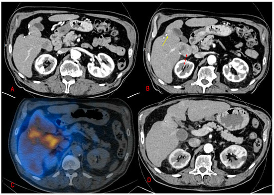 Efficacy of Selective Internal Radiation Therapy for Hepatocellular ...