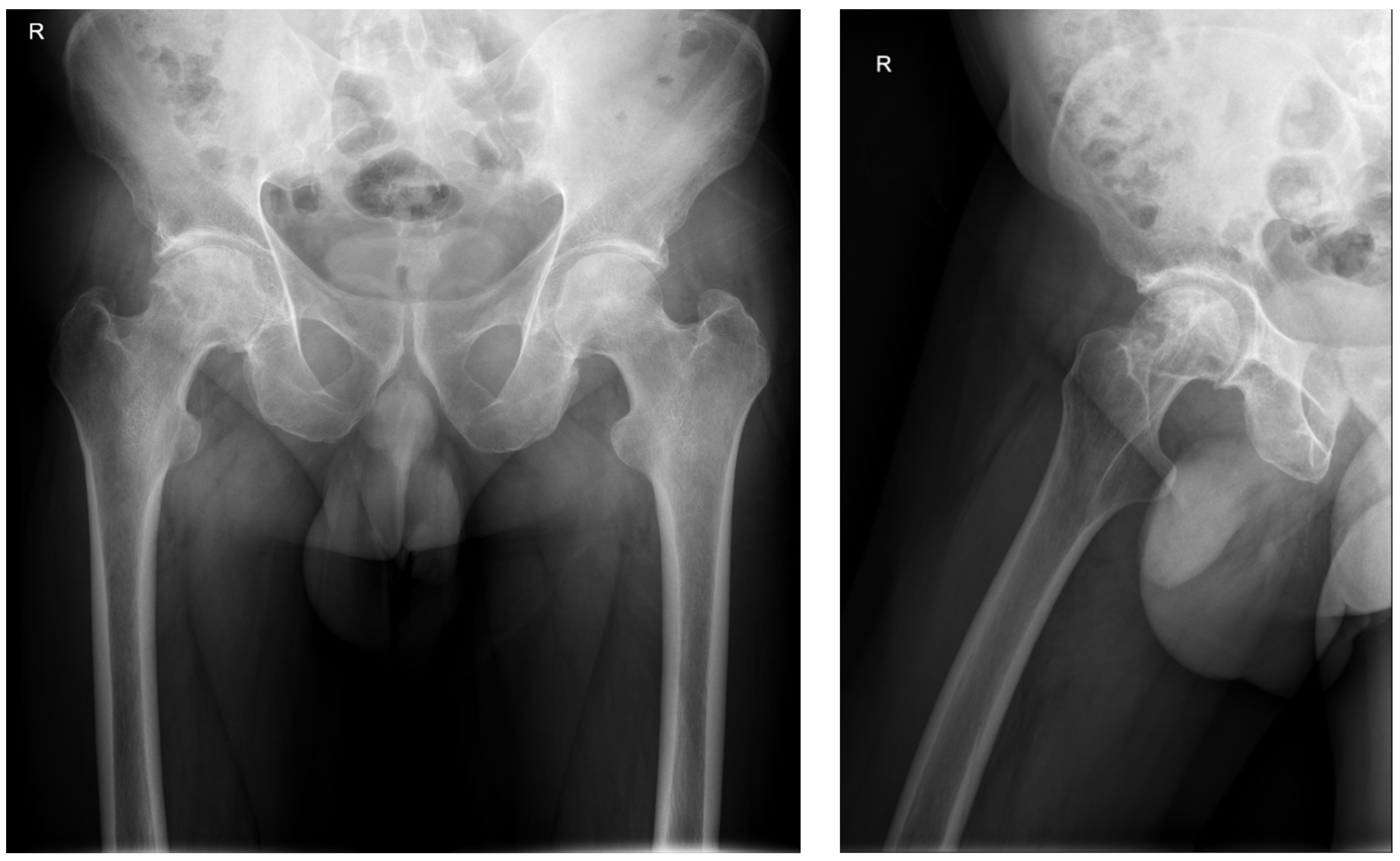 Uncommon Septic Arthritis of the Hip Joint in an Immunocompetent Adult ...