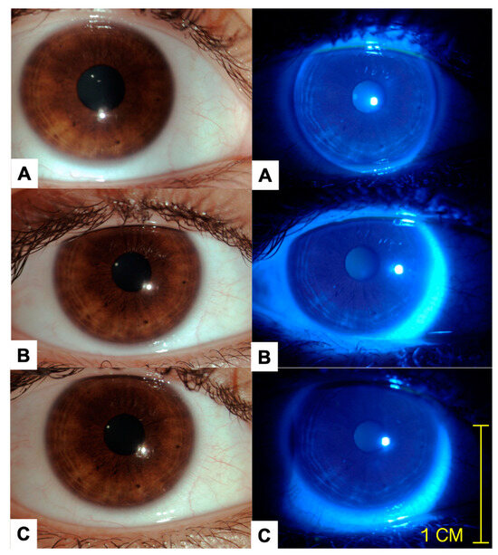 Enhancing Ocular Surface in Dry Eye Disease Patients: A Clinical ...
