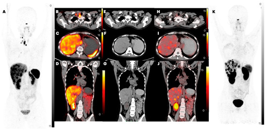 Head-to-Head Comparison of SSTR Antagonist [68Ga]Ga-DATA5m-LM4 with ...