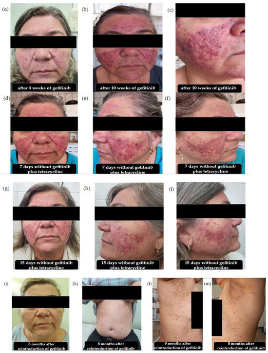 Gefitinib-Induced Severe Dermatological Adverse Reactions: A Case ...